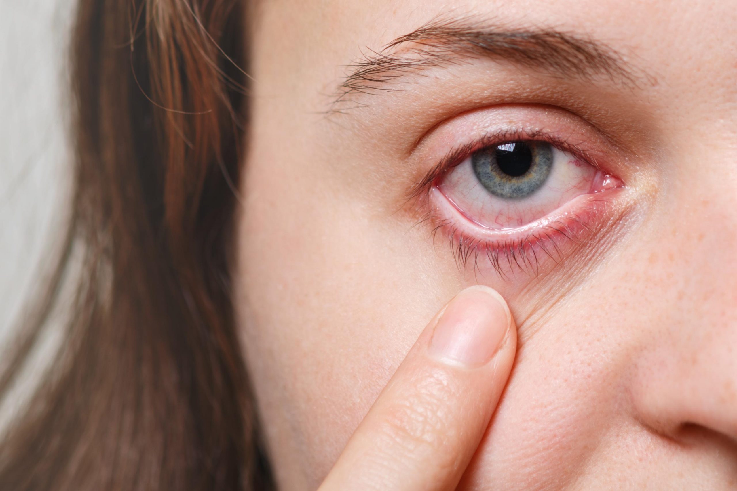 Dry Eyes Cure - Natural Remedies (Home) With Permanent Cure
